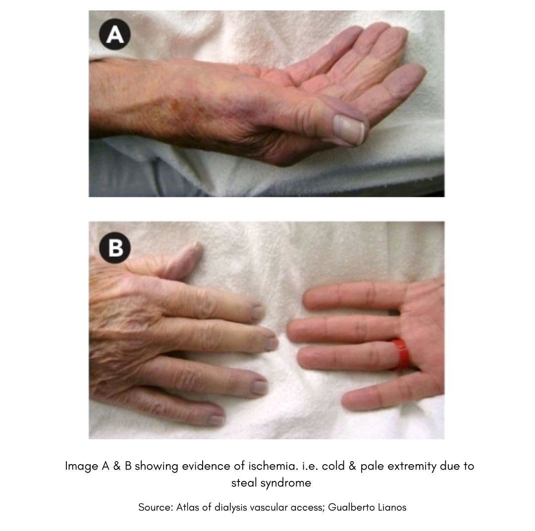 8 Methods To Inspect An AV Fistula – LazyKidney