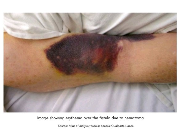 8 Methods To Inspect An AV Fistula – LazyKidney